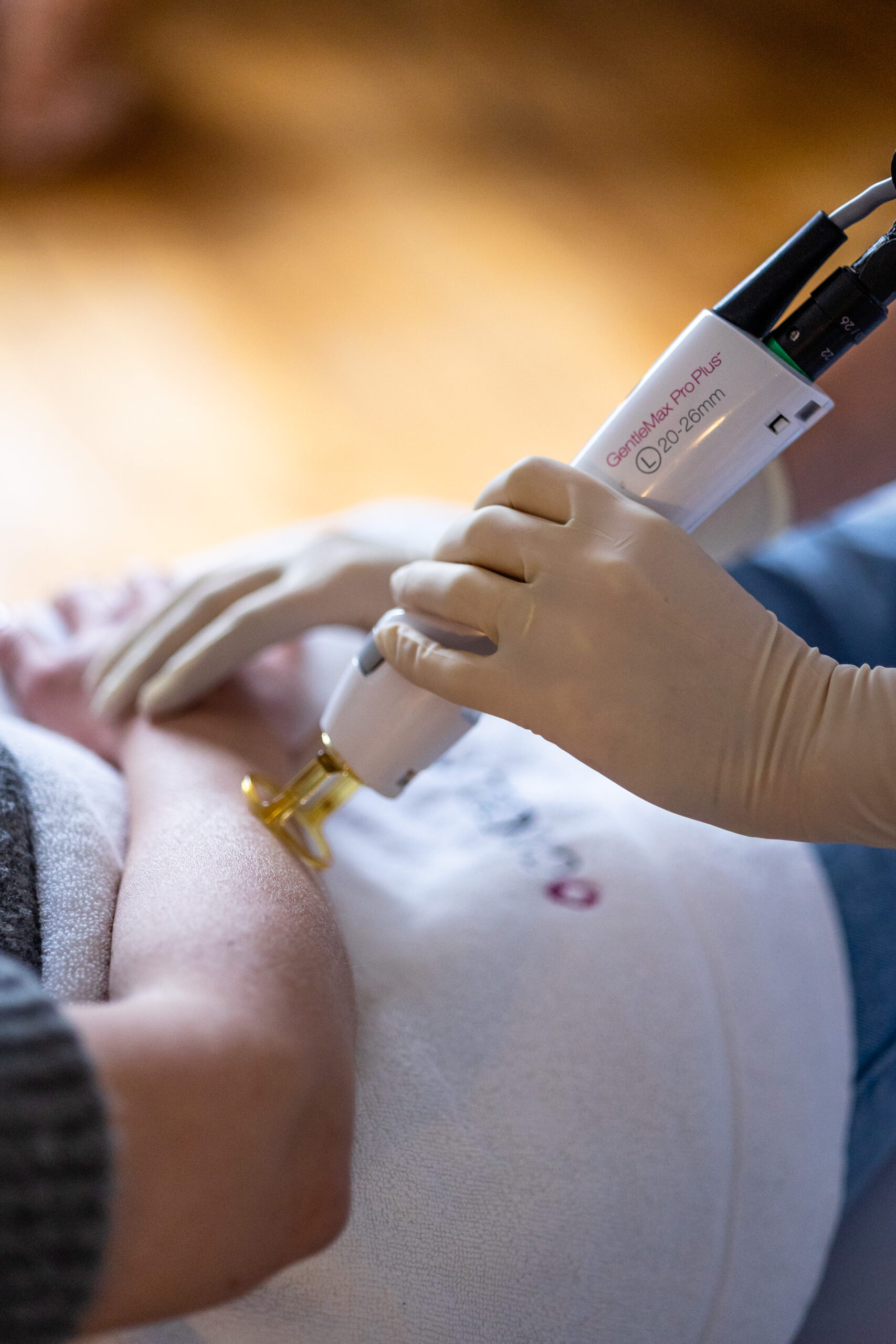 Laserontharing - GentleMax Pro Plus | Medi Derma Clinic